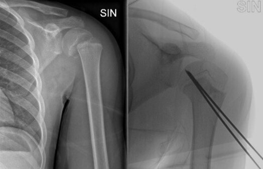 Fratture del piatto di crescita o distacchi epifisari - Ospedale ...
